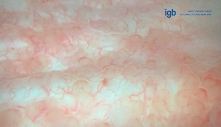 ¿Qué aspecto tiene una vejiga con cistitis crónica? - Instituto ...
